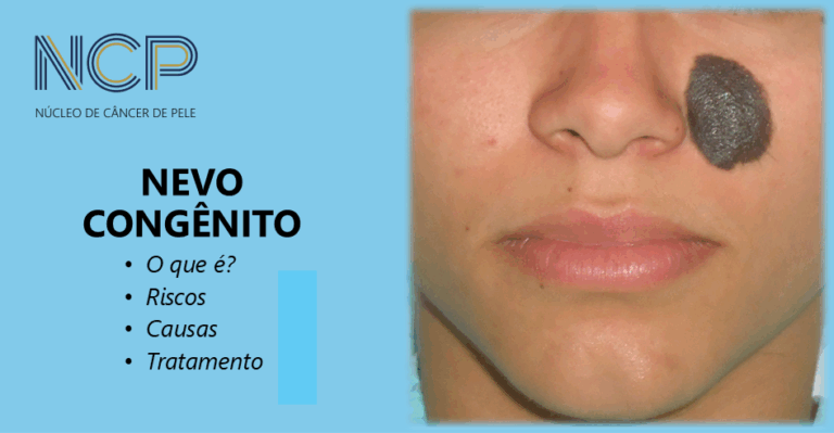 NEVO CONGÊNITO – Núcleo de Câncer de Pele